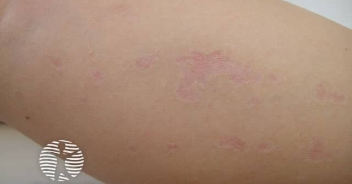 Linear porokeratosis image