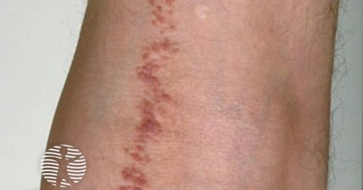 Lichen striatus image