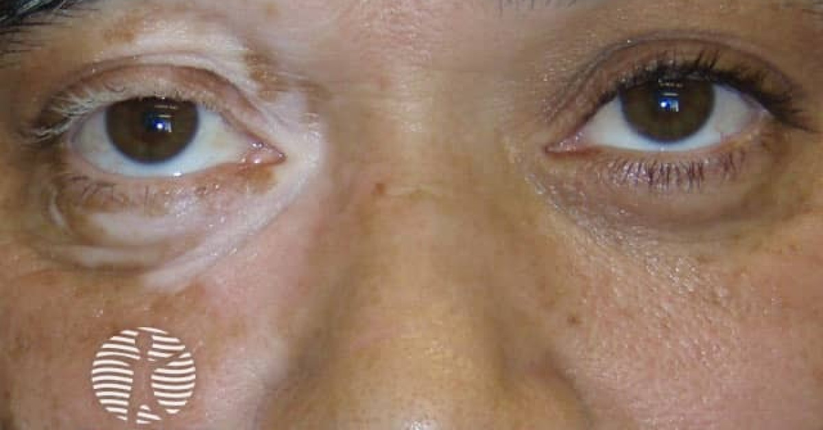 Segmental vitiligo image
