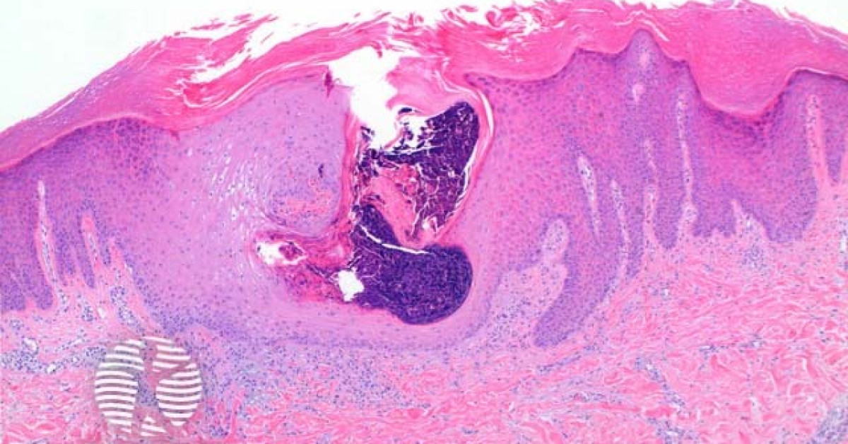 Reactive perforating collagenosis pathology image
