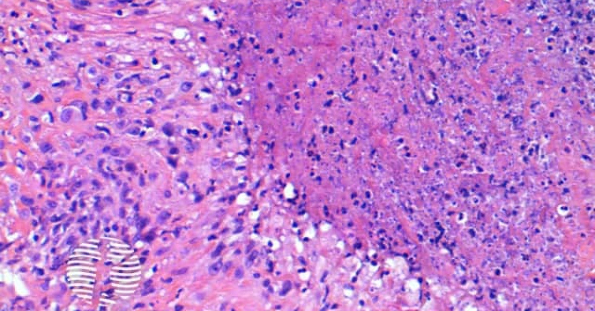 Granuloma annulare pathology image