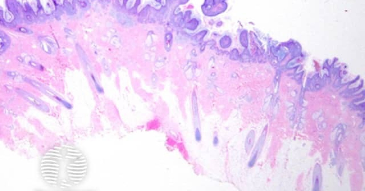 Epidermal naevus pathology image
