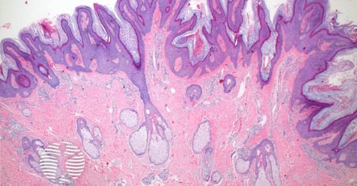 Epidermal naevus pathology image