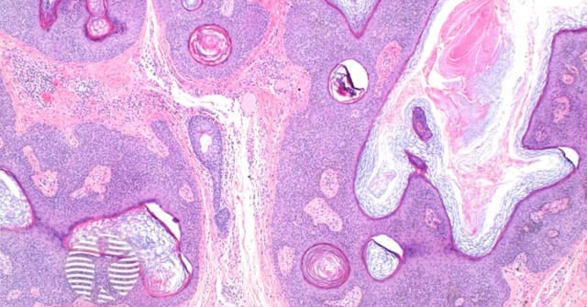 Epidermal naevus pathology image