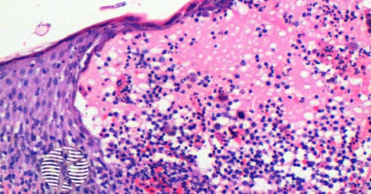 Herpes virus infection pathology image