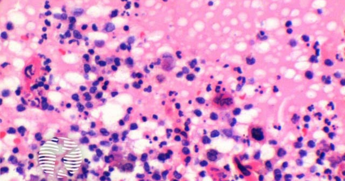 Herpes virus infection pathology image