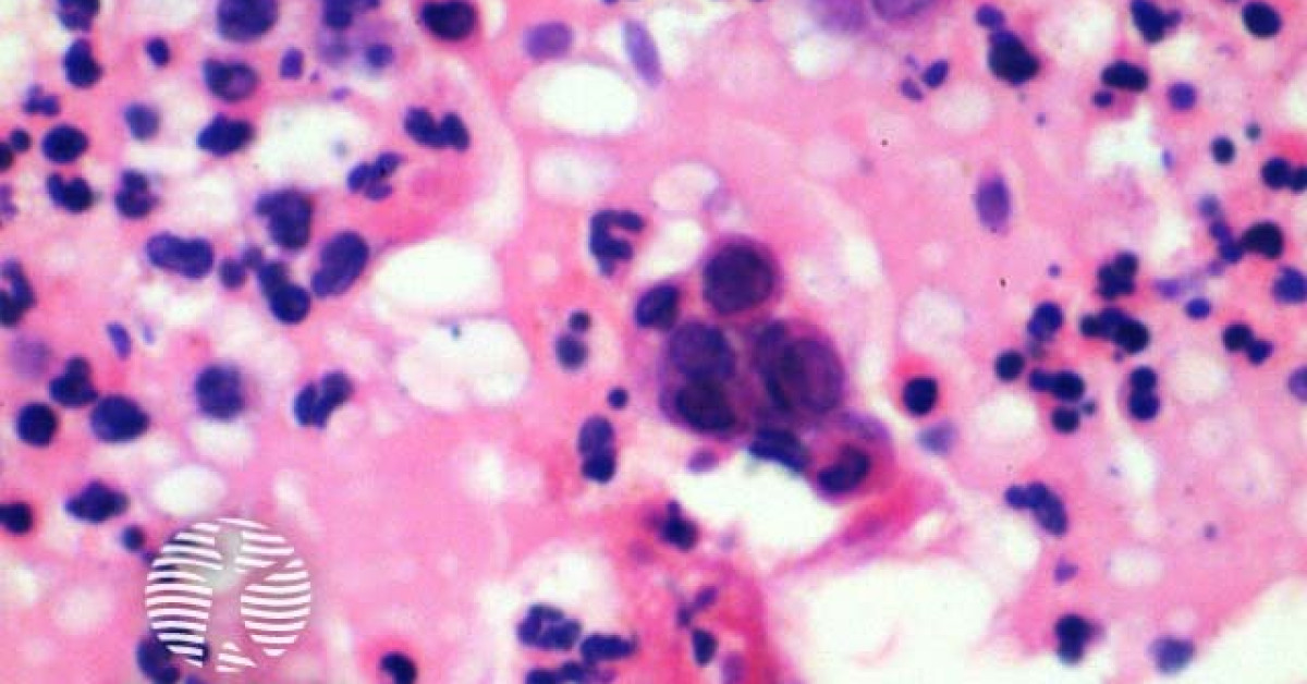 Herpes virus infection pathology image