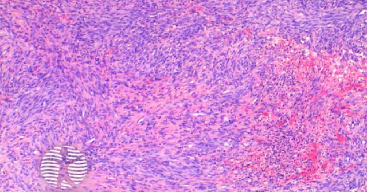 Kaposi sarcoma pathology image