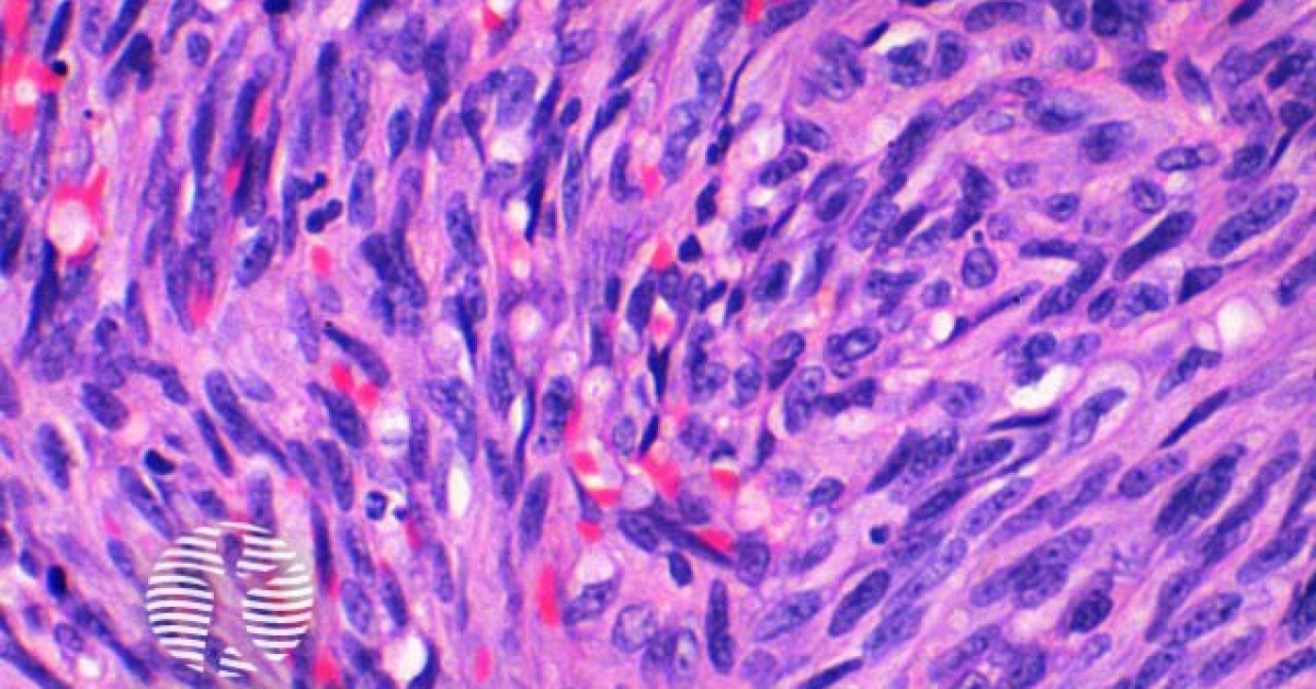 Kaposi sarcoma pathology image