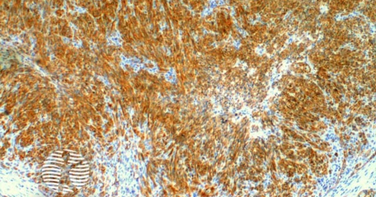 Kaposi sarcoma pathology CD31 stain image