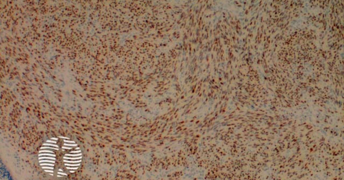 Kaposi sarcoma pathology HHV-8 stain image