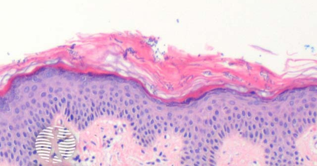 Pityriasis versicolor pathology image
