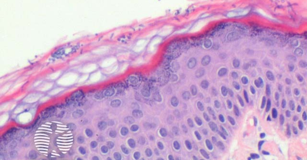 Pityriasis versicolor pathology image