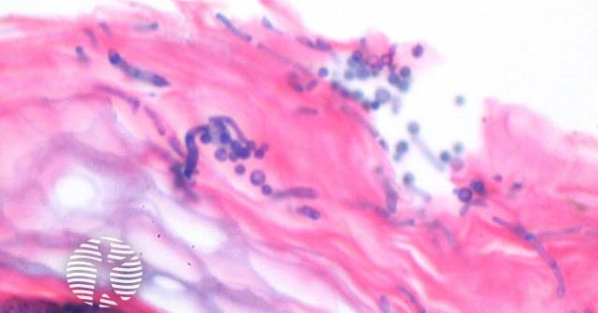 Pityriasis versicolor pathology image