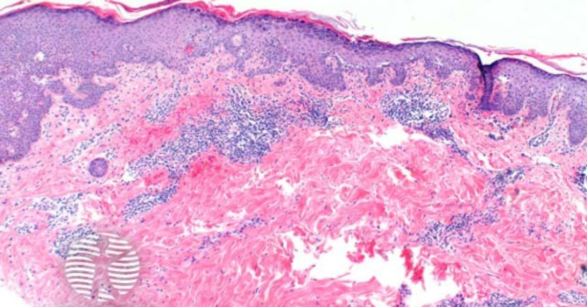 Pemphigus foliaceus pathology image