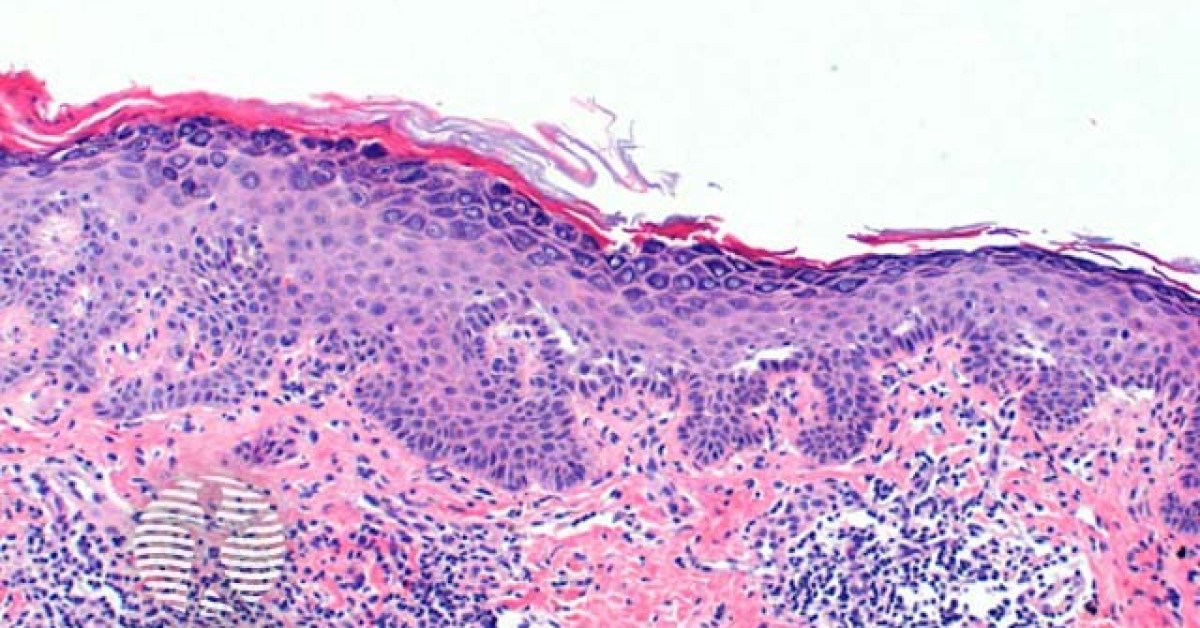 Pemphigus foliaceus pathology image