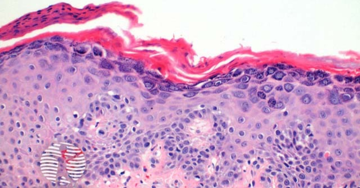 Pemphigus foliaceus pathology image