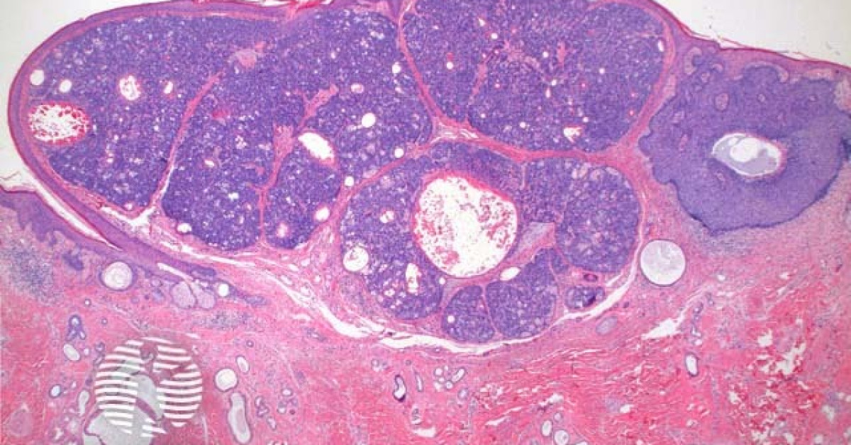 Sebaceoma pathology image