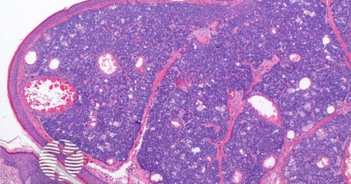 Sebaceoma pathology image