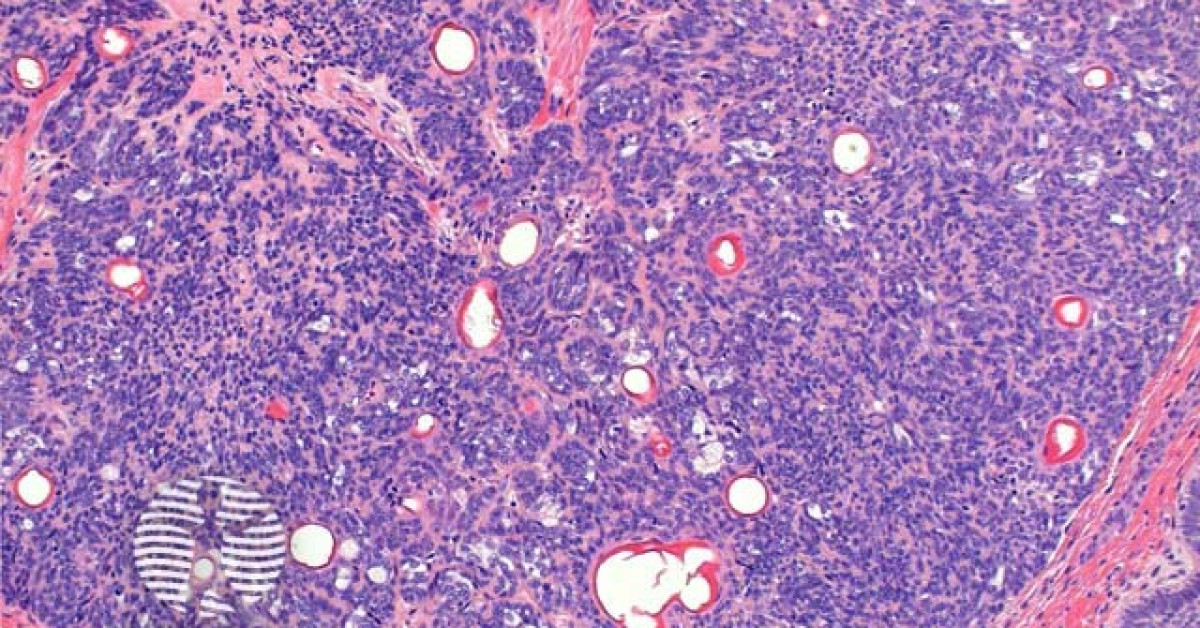 Sebaceoma pathology image