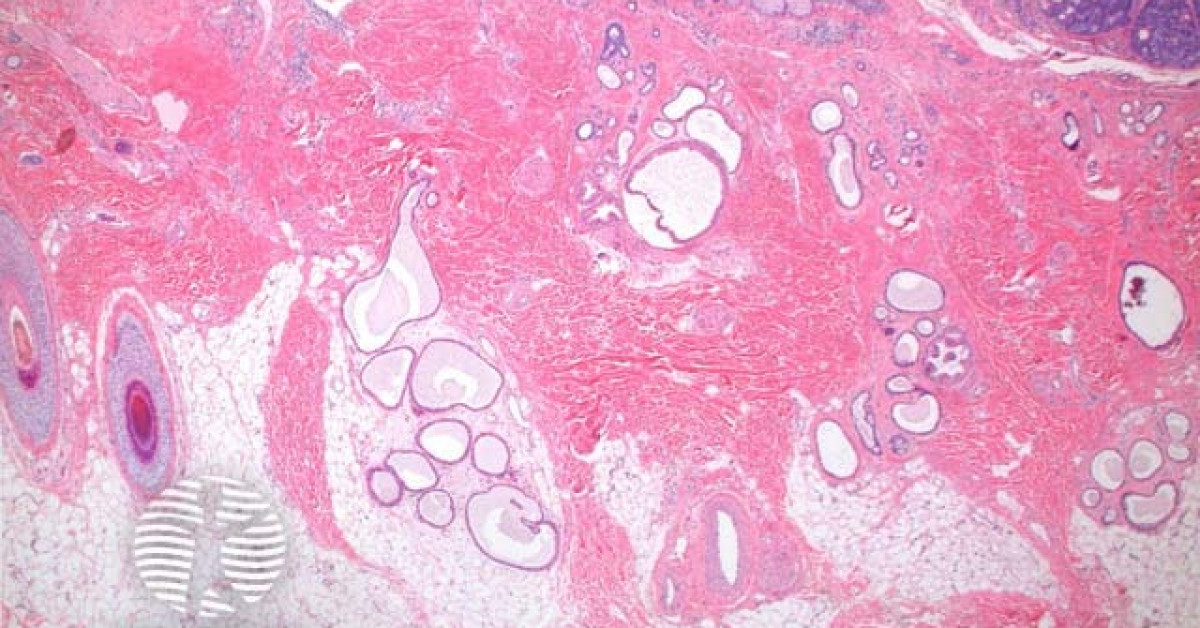 Sebaceoma in naevus sebaceous pathology image