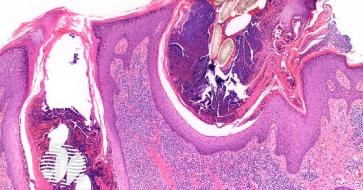 Histologia Da Acne Keloidalis Nuchae Folliculitis Keloidalis