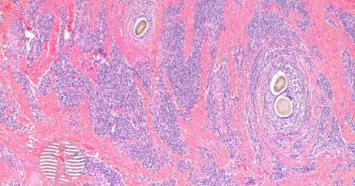 Acne keloidalis nuchae pathology image