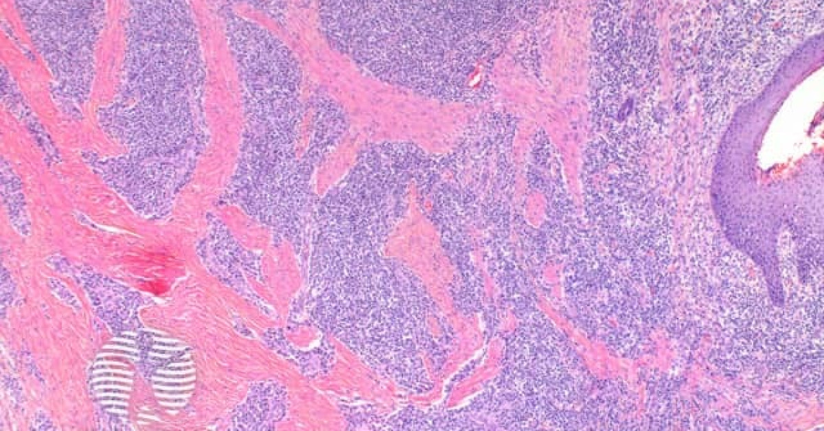 Acne keloidalis nuchae pathology image