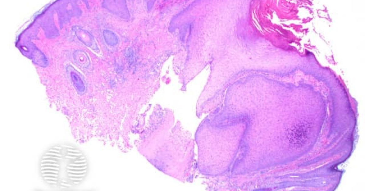 Chondrodermatitis nodularis helicis pathology image