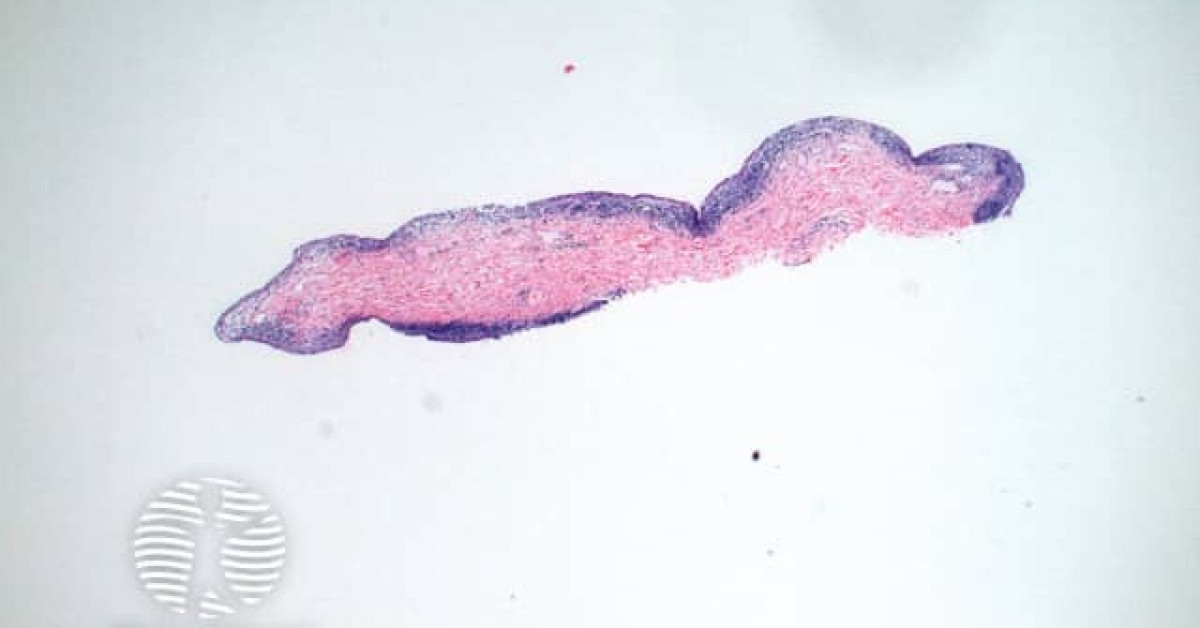 Conjunctivitis pathology image