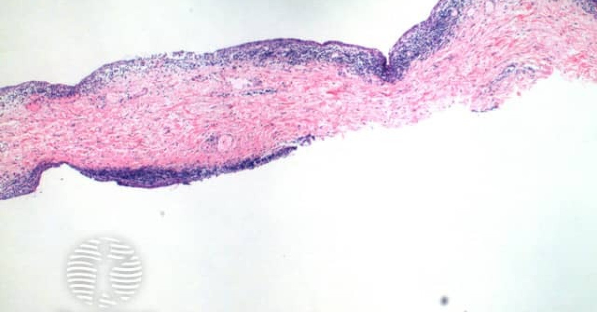 Conjunctivitis pathology image