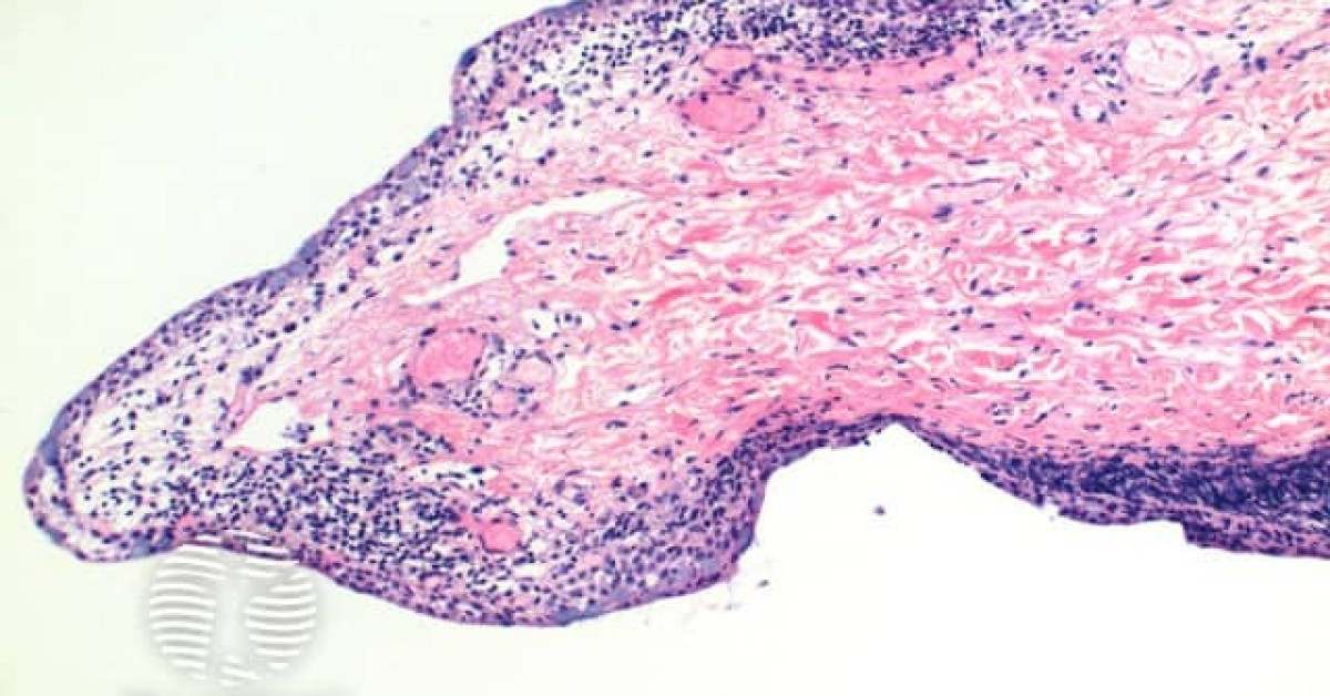 Conjunctivitis pathology image