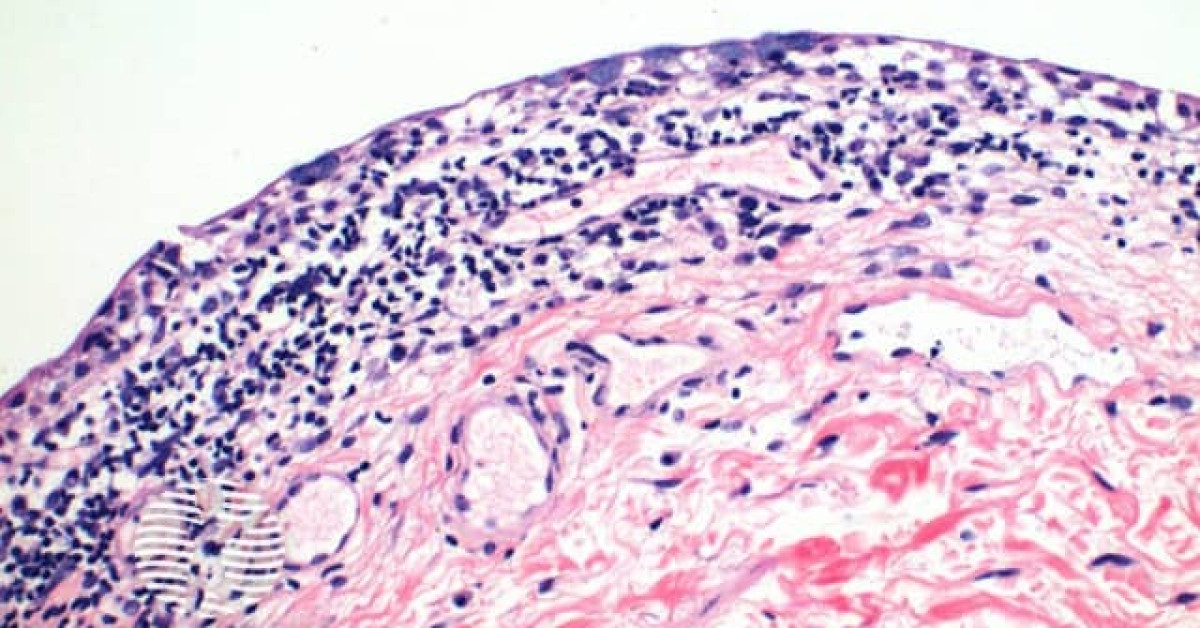 Conjunctivitis pathology image