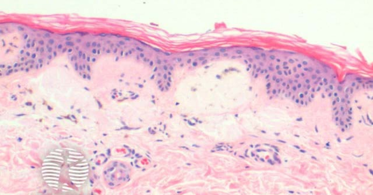Primary cutaneous amyloidosis pathology image