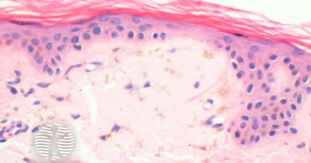 Primary cutaneous amyloidosis pathology image