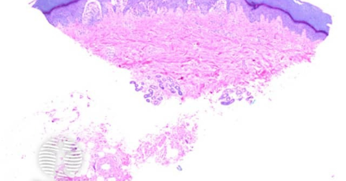 Dermatitis herpetiformis pathology image