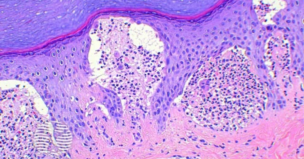 Dermatitis herpetiformis pathology image