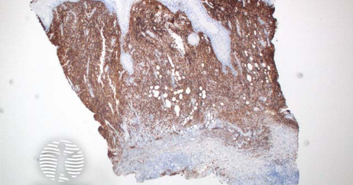 Primary cutaneous diffuse large B cell lymphoma pathology image