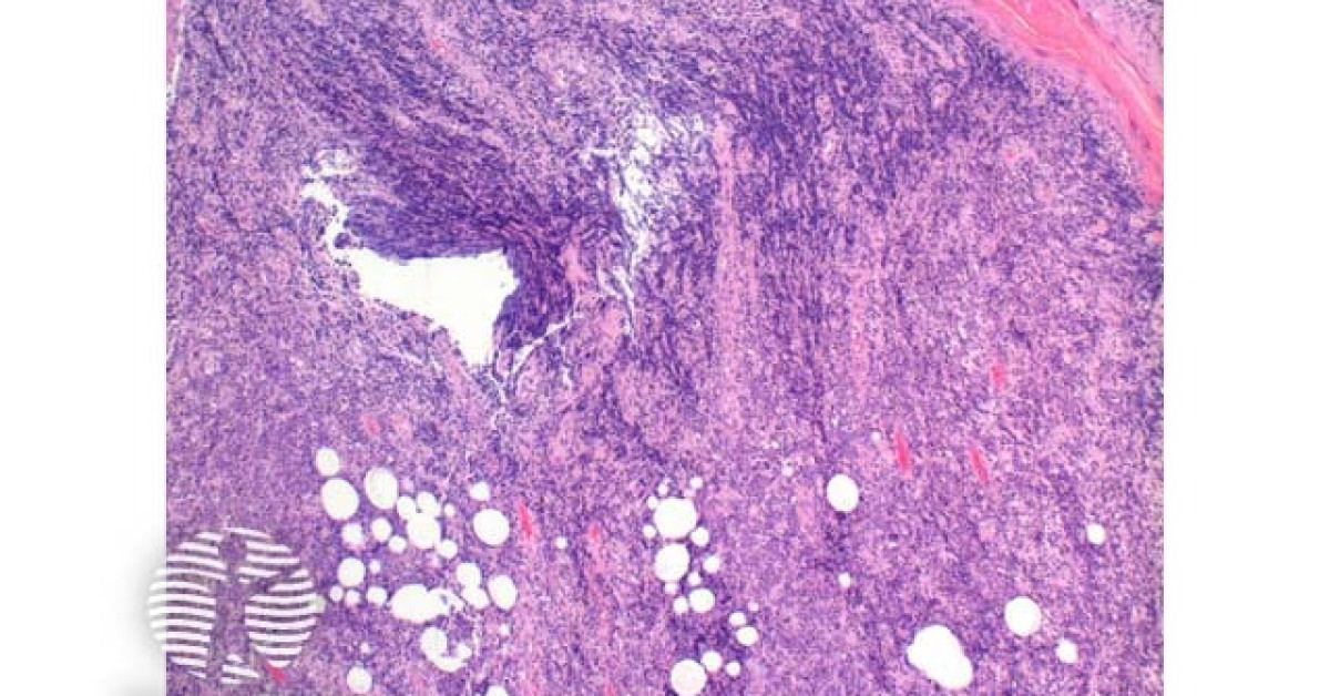 Primary cutaneous diffuse large B cell lymphoma pathology image