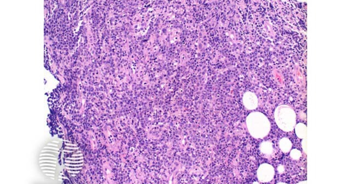 Primary cutaneous diffuse large B cell lymphoma pathology image