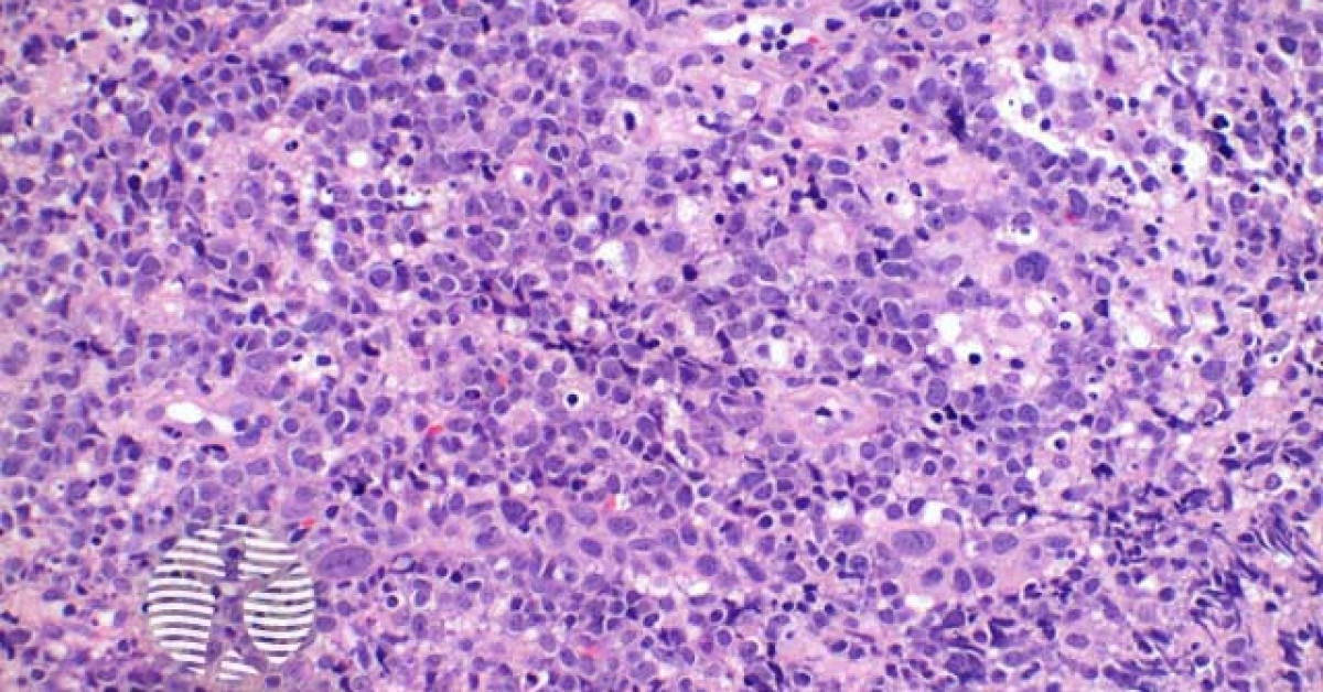 Primary cutaneous diffuse large B cell lymphoma pathology image