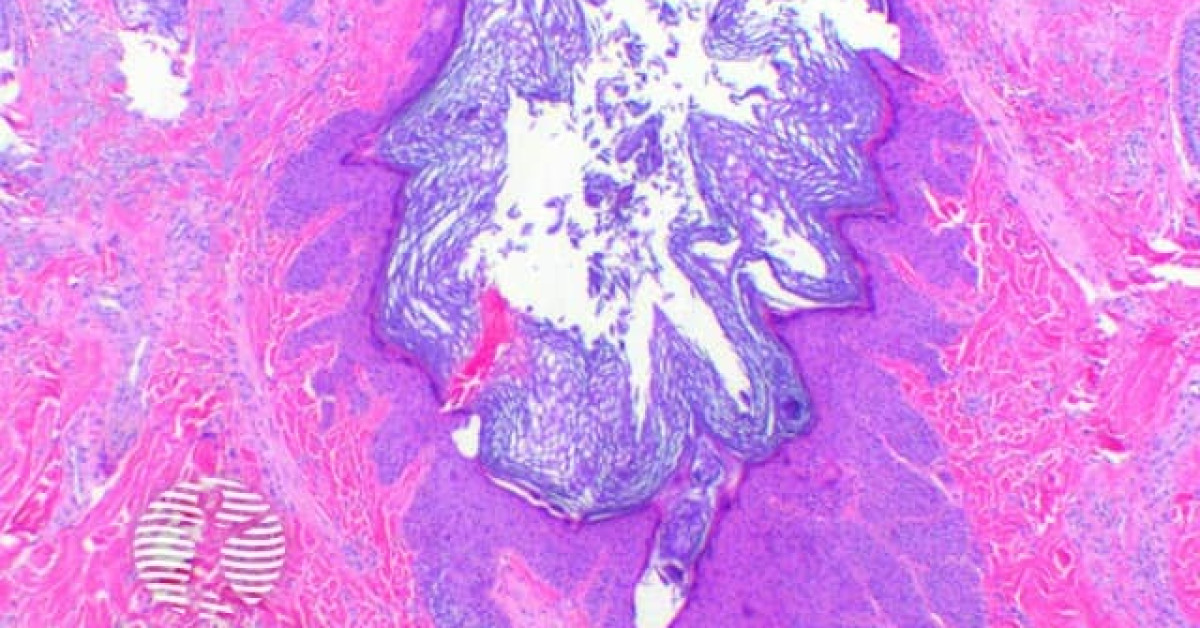 Dilated Pore Of Winer Pathology Image
