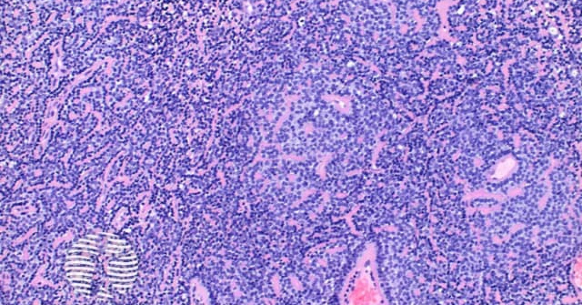 Eccrine spiradenoma pathology image