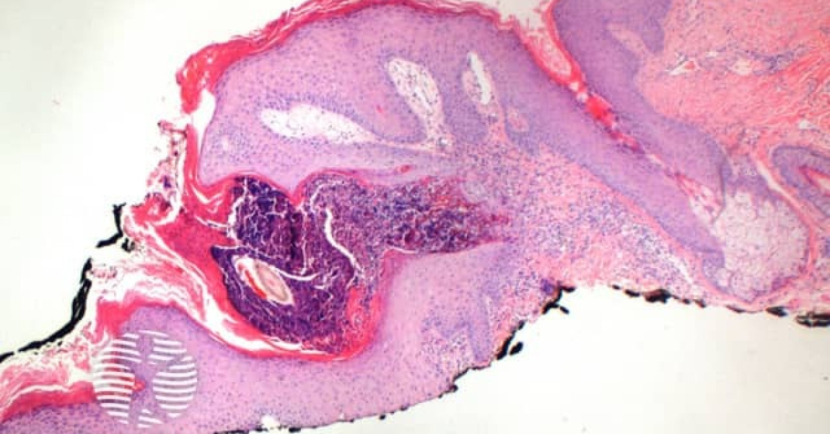 Elastosis perforans serpiginosa pathology image