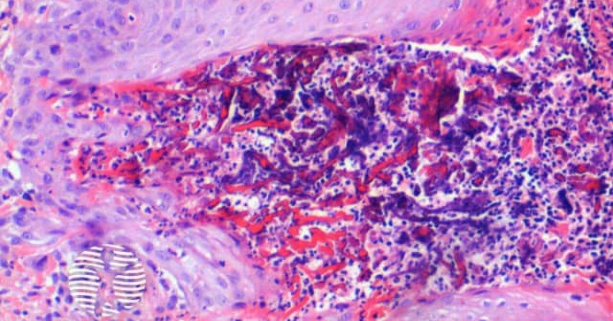 Elastosis perforans serpiginosa pathology image