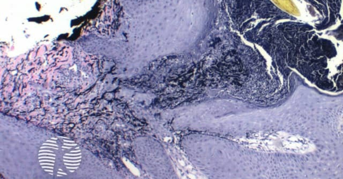 Elastosis perforans serpiginosa pathology image