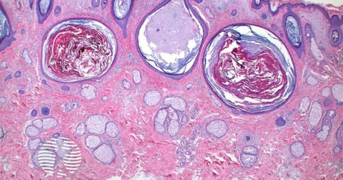 Favre-Racouchot syndrome image