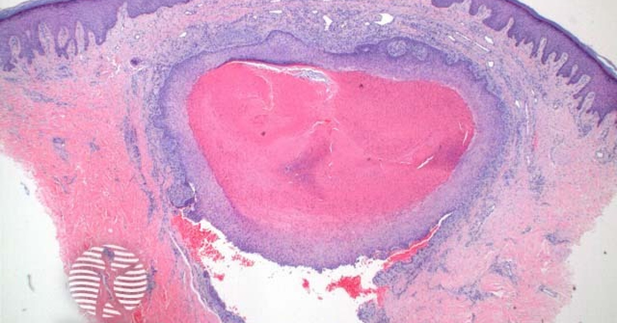 Trichilemmal cyst pathology image