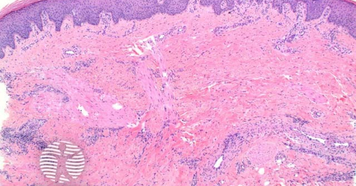 Necrobiosis lipoidica pathology image