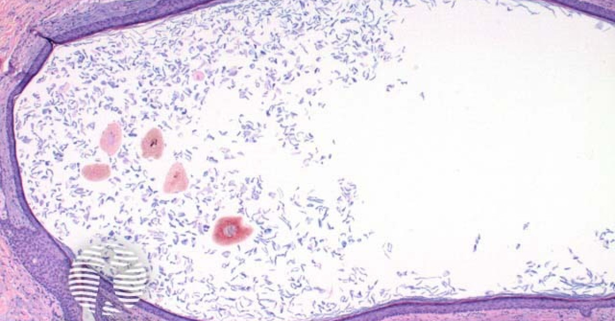 Primary cutaneous amyloidosis pathology image